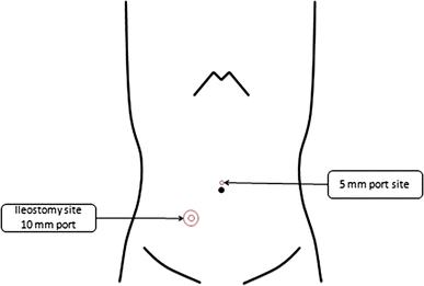 Laparoscopic loop ileostomy with a single-port stab incision technique ...