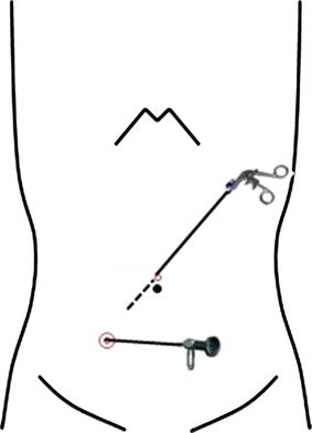 Laparoscopic loop ileostomy with a single-port stab incision technique ...