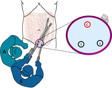 Single-incision laparoscopic colectomy: a novel approach through a ...