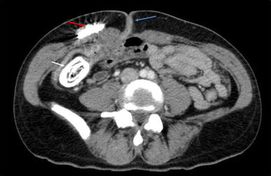 Malone appendicostomy: an unexpected complication | SpringerLink