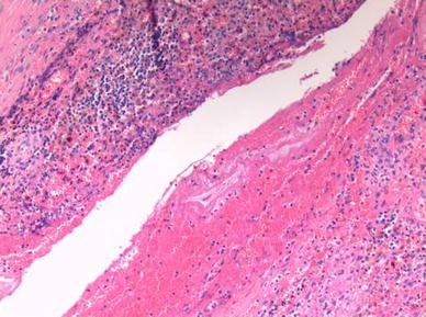 Identification of epithelialization in high transsphincteric fistulas ...