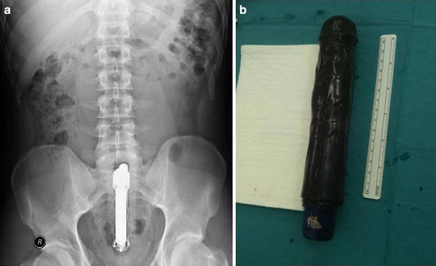 Approach to the diagnosis and management of retained rectal foreign ...