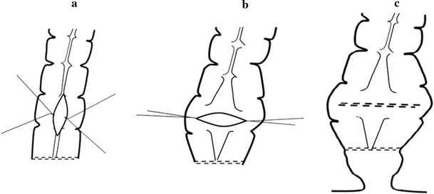 Low anterior resection syndrome (LARS): cause and effect and ...