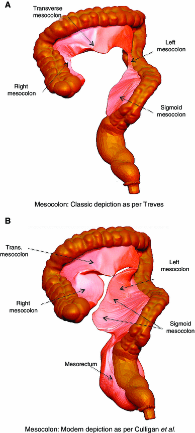 Digital sculpting in surgery: a novel approach to depicting mesosigmoid ...