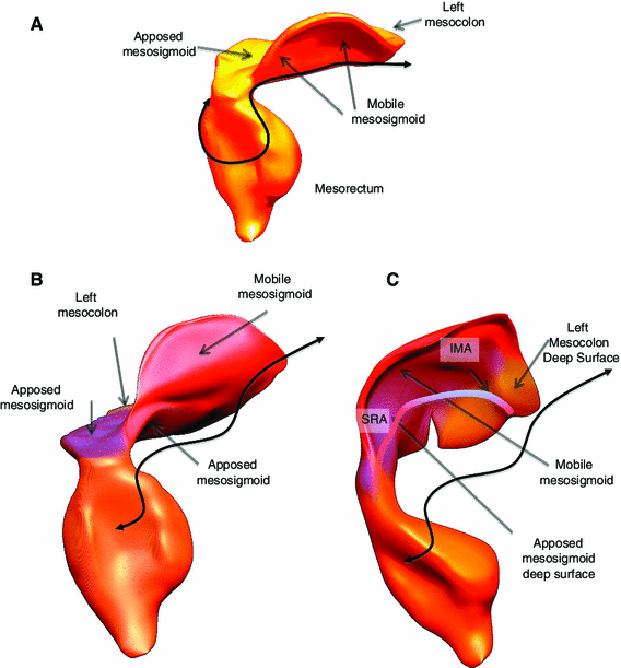 Digital sculpting in surgery: a novel approach to depicting mesosigmoid ...