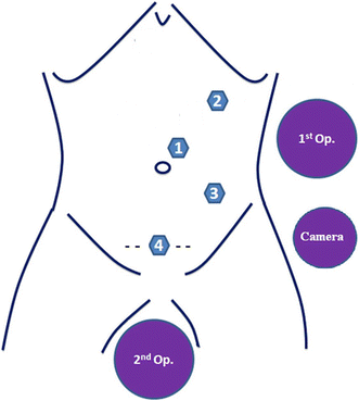Single-layer versus double-layer closure of the enterotomy in ...