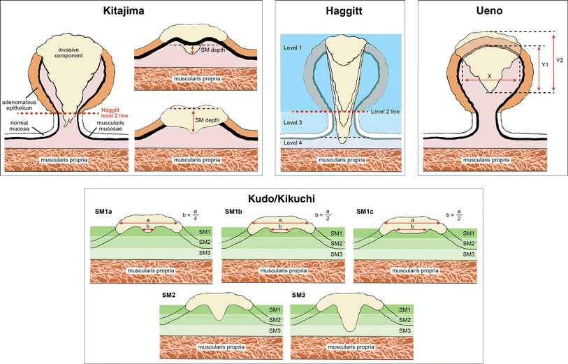 Interobserver variability amongst gastrointestinal pathologists in ...