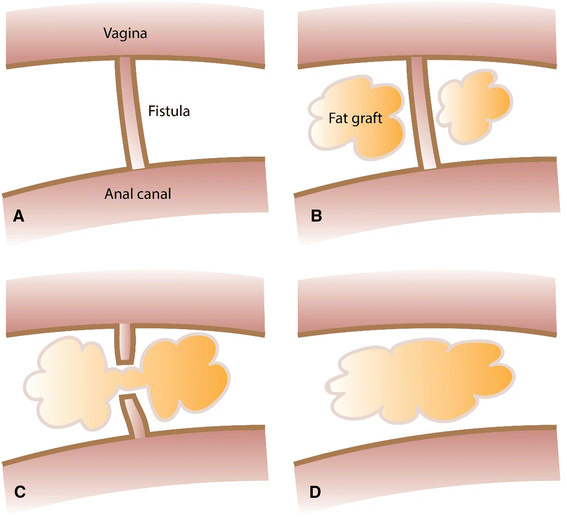 Efficacy of autologous fat graft injection in the treatment of ...