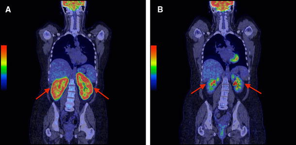 Utility of FDG-PET in primary renal lymphoma | SpringerLink