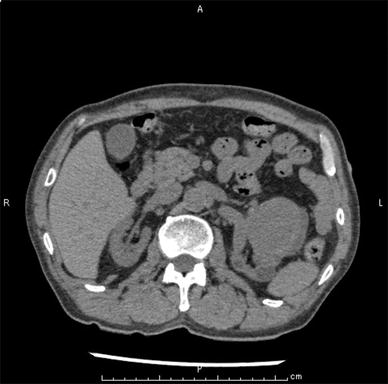 Renal arteriovenous fistula | SpringerLink
