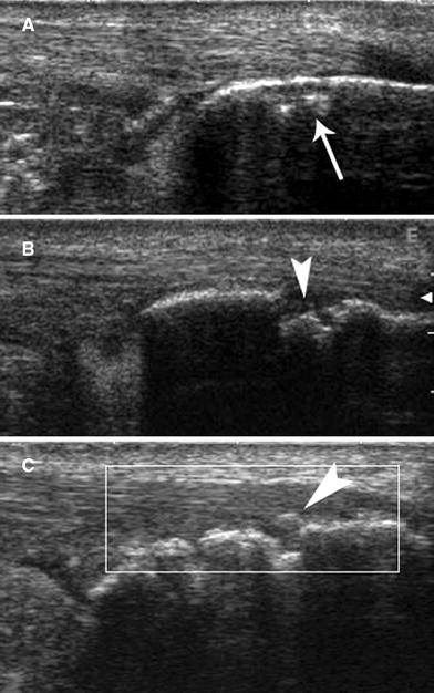Ultrasound of enthesopathy in rheumatic diseases | SpringerLink