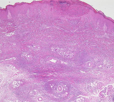 Cutaneous necrobiotic conditions associated with rheumatoid arthritis ...