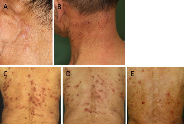 Investigations of IgG4-related disease involving the skin | SpringerLink