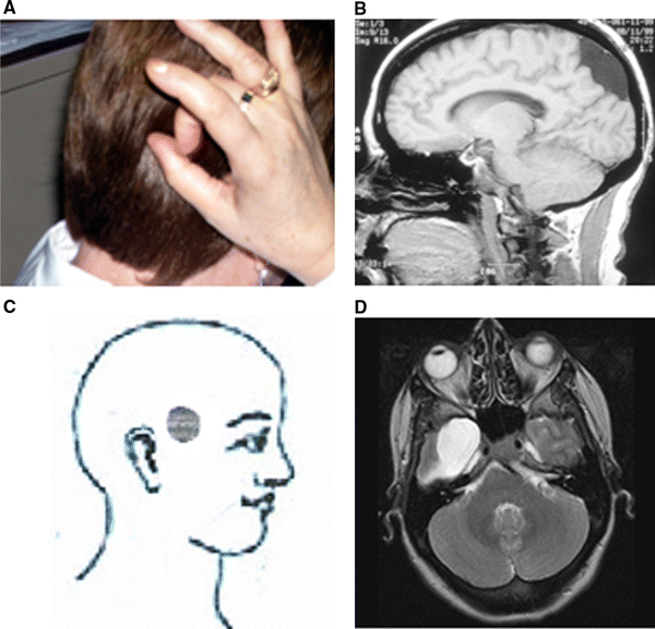 Nummular headache associated to arachnoid cysts | SpringerLink