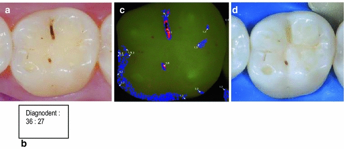 Caries diagnosis using light fluorescence devices: VistaProof and ...