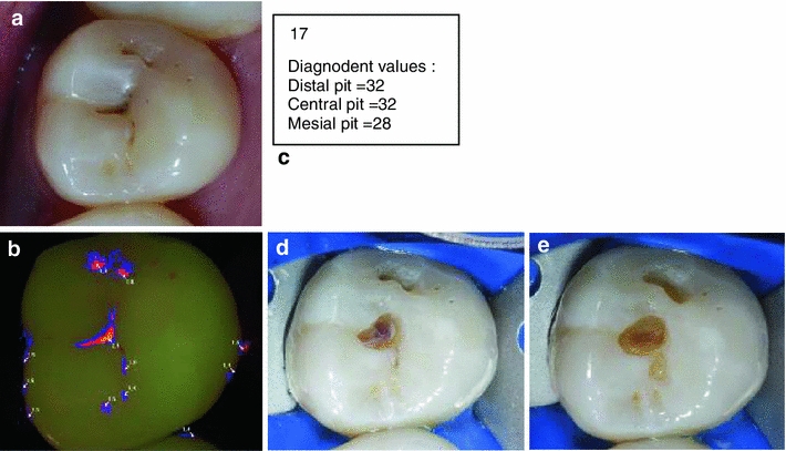 Caries diagnosis using light fluorescence devices: VistaProof and ...