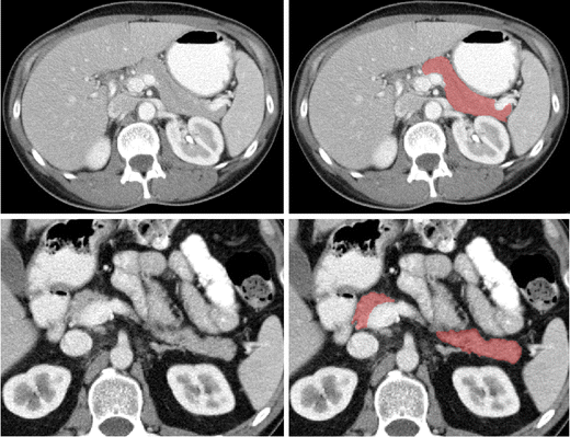 Model-Based Pancreas Segmentation in Portal Venous Phase Contrast ...