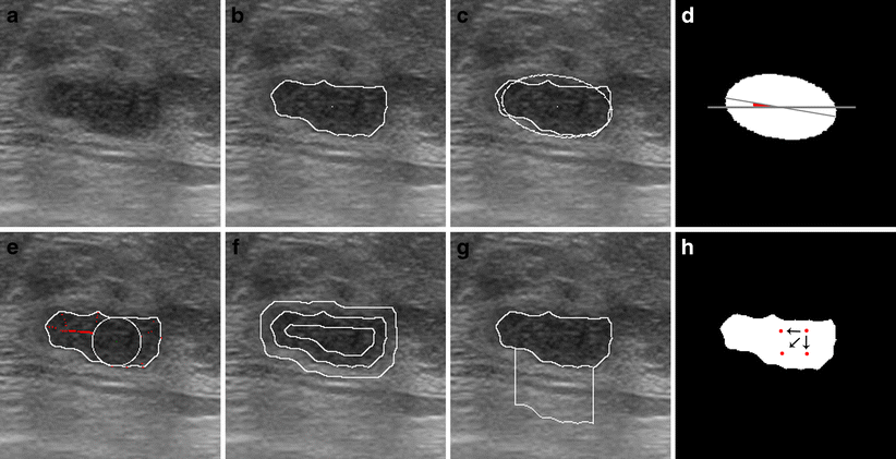 Quantitative Ultrasound Analysis for Classification of BI-RADS Category ...