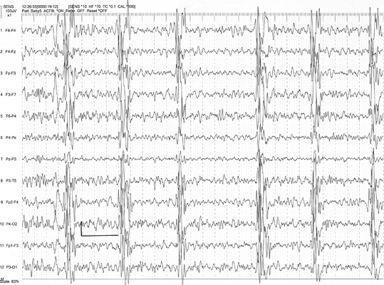 Richtungweisende EEG-Muster im Kindesalter | SpringerLink