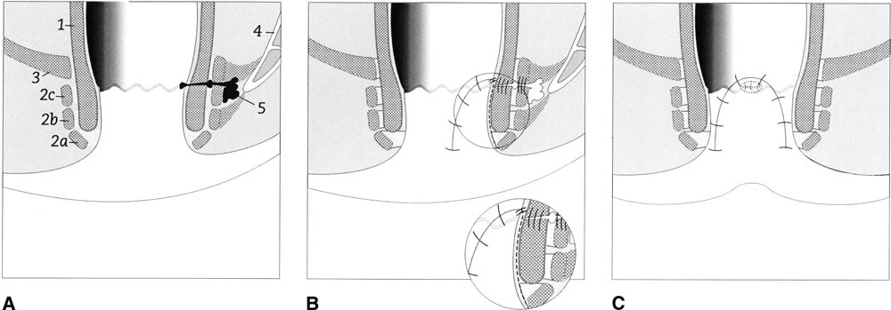 Treatment for Horseshoe Fistulas-In-Ano with Primary Closure of the ...
