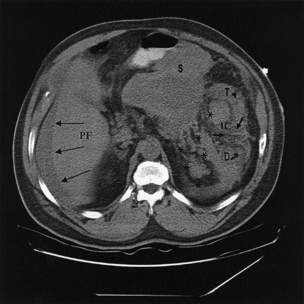 Spontaneous Colonic Mesenteric Hemorrhage: Report of an Unusual Case of ...