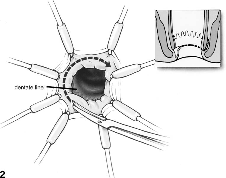 Technique and Long-Term Results of Intersphincteric Resection for Low ...
