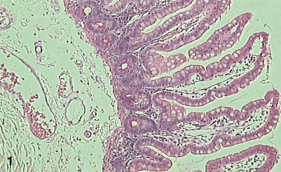 Ileitis in Ulcerative Colitis: Is It a Backwash? | SpringerLink