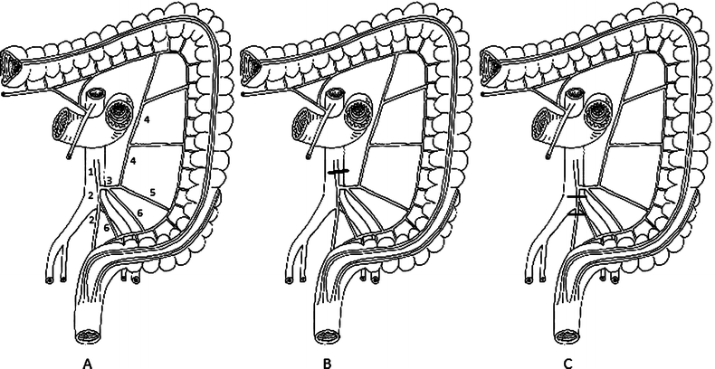 Level of Arterial Ligation in Rectal Cancer Surgery: Low Tie Preferred ...