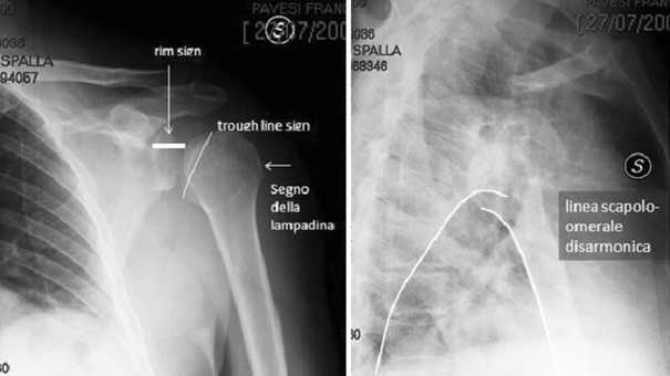 Lussazioni posteriori della scapolo-omerale: diagnosi e terapia ...