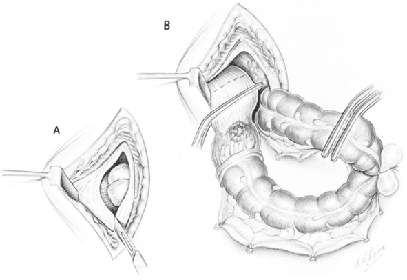 The development of sphincter saving surgery for rectal cancer: the long ...