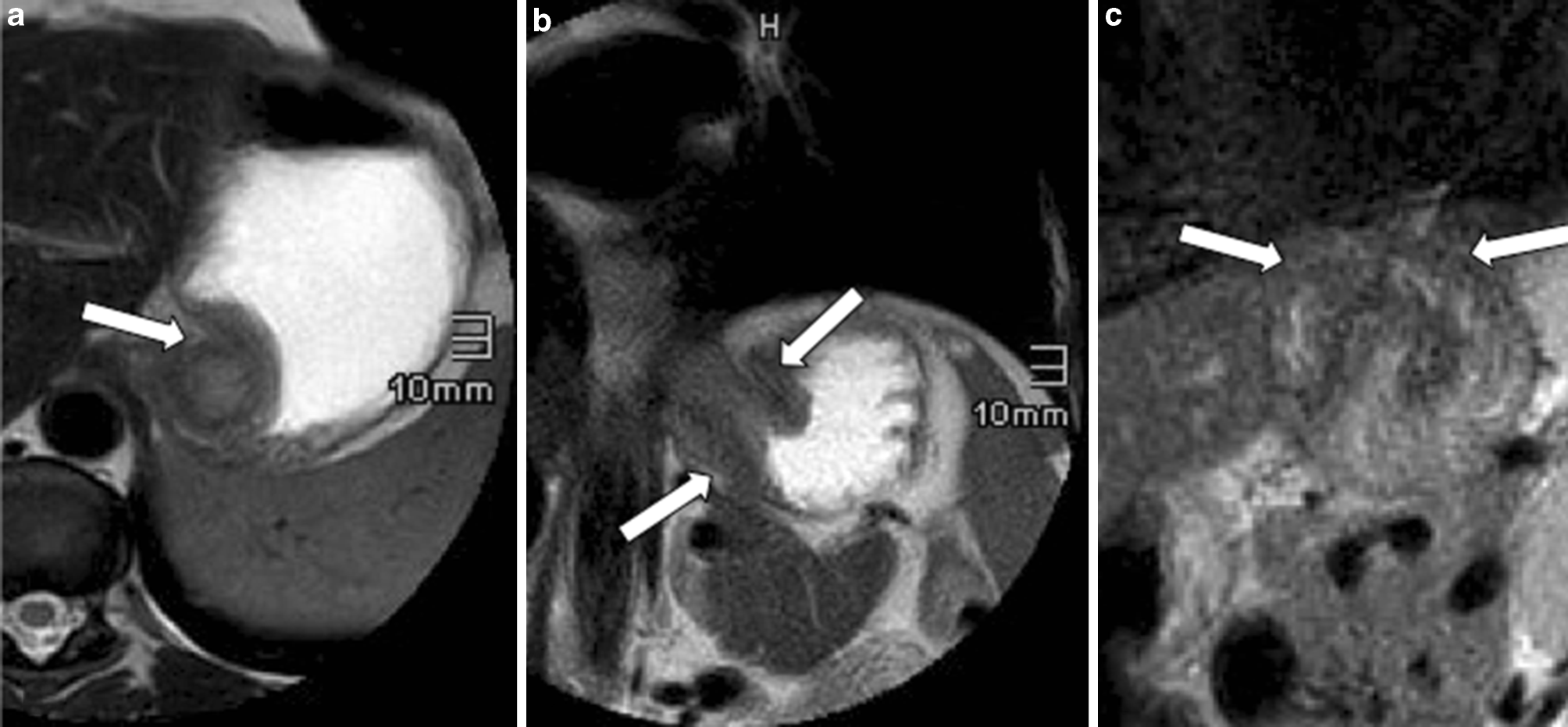 Swallowing MRI for GERD—diagnosis and treatment monitoring | SpringerLink