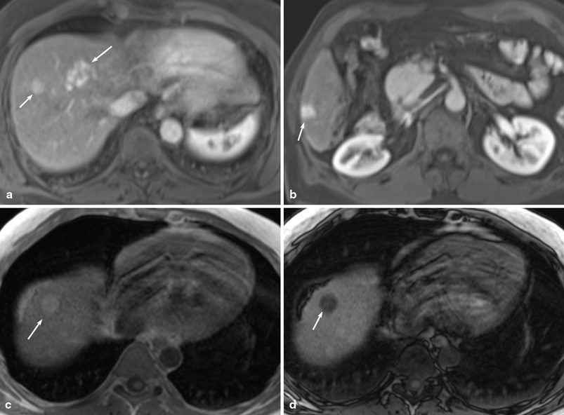 Radiologische Diagnostik primärer Lebermalignome | SpringerLink