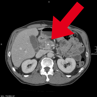 Clinical approach to the patient with a solid pancreatic mass ...