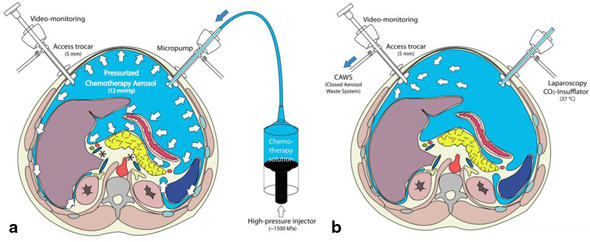 Pressurized intraperitoneal chemotherapy (PIPAC) in women with ...