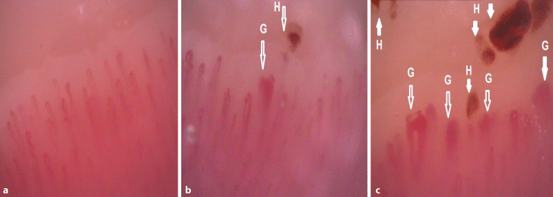 Mosaic capillaroscopic findings in systemic sclerosis | SpringerLink