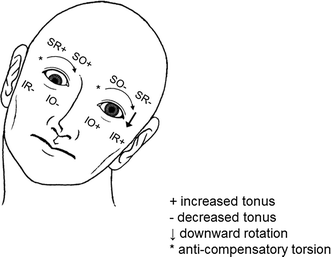 Effects of inferior oblique muscle-weakening surgery on the ...