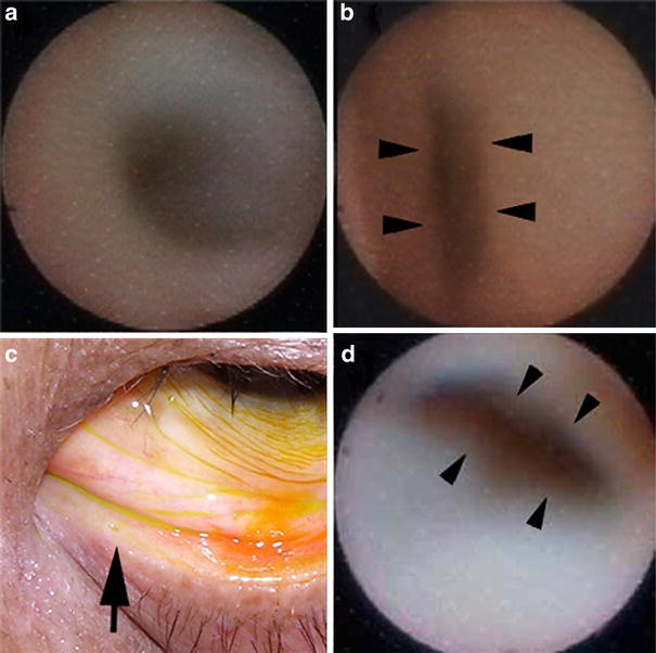 Dacryoendoscopic observation and incidence of canalicular obstruction ...