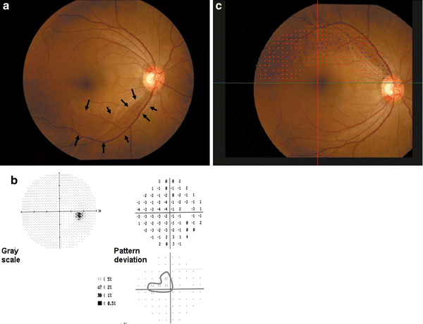 Detection of visual field defects in pre-perimetric glaucoma using ...