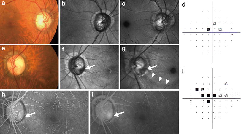 Bilateral papillomacular retinoschisis and macular detachment ...