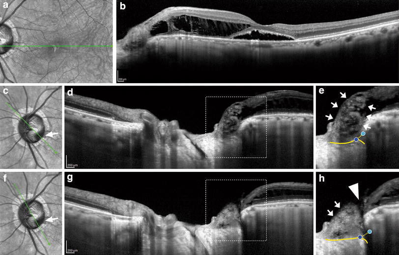 Bilateral papillomacular retinoschisis and macular detachment ...