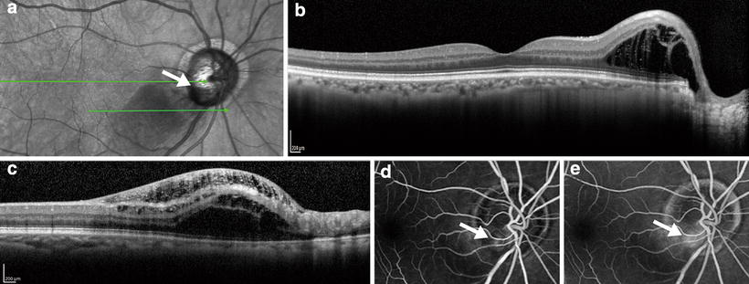 Bilateral papillomacular retinoschisis and macular detachment ...