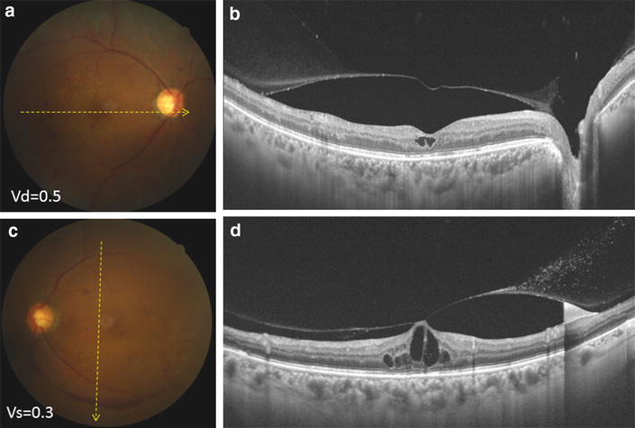 Vitreous anatomy and the vitreomacular correlation | SpringerLink