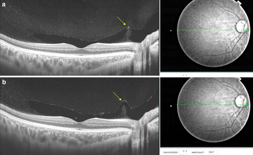 Vitreous anatomy and the vitreomacular correlation | SpringerLink
