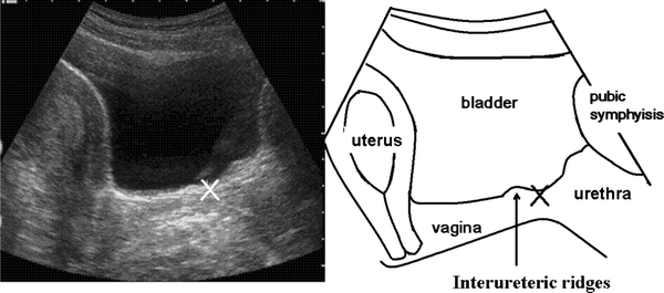 Evaluation of pelvic floor function by transabdominal ultrasound in ...