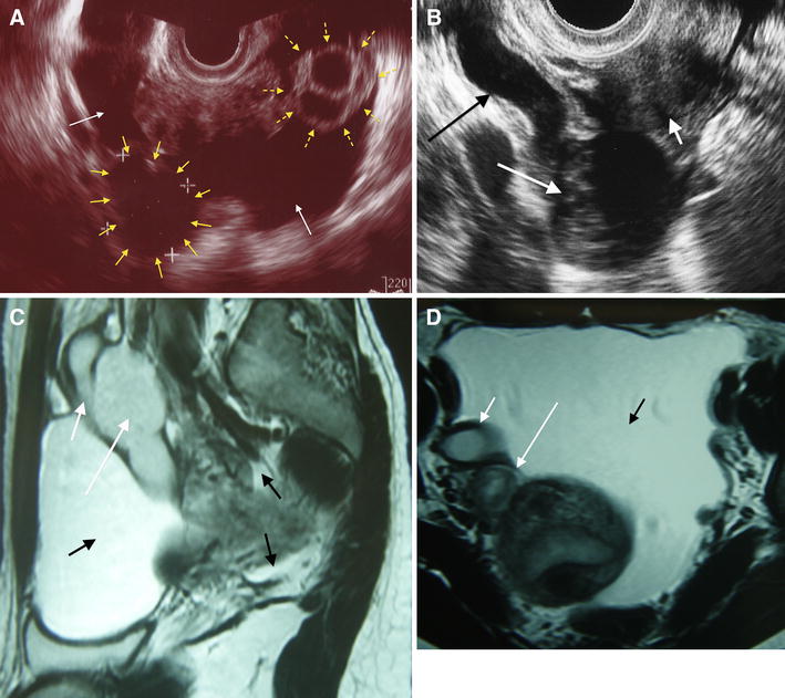Appendiceal mucocele and peritoneal inclusion cyst mimicking right ...
