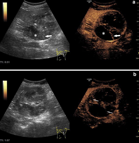 Splenic cystic lymphangioma with atypical ultrasound findings ...