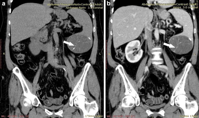 Splenic cystic lymphangioma with atypical ultrasound findings ...