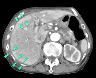 Elderly Fitz-Hugh–Curtis syndrome observed with superb microvascular ...