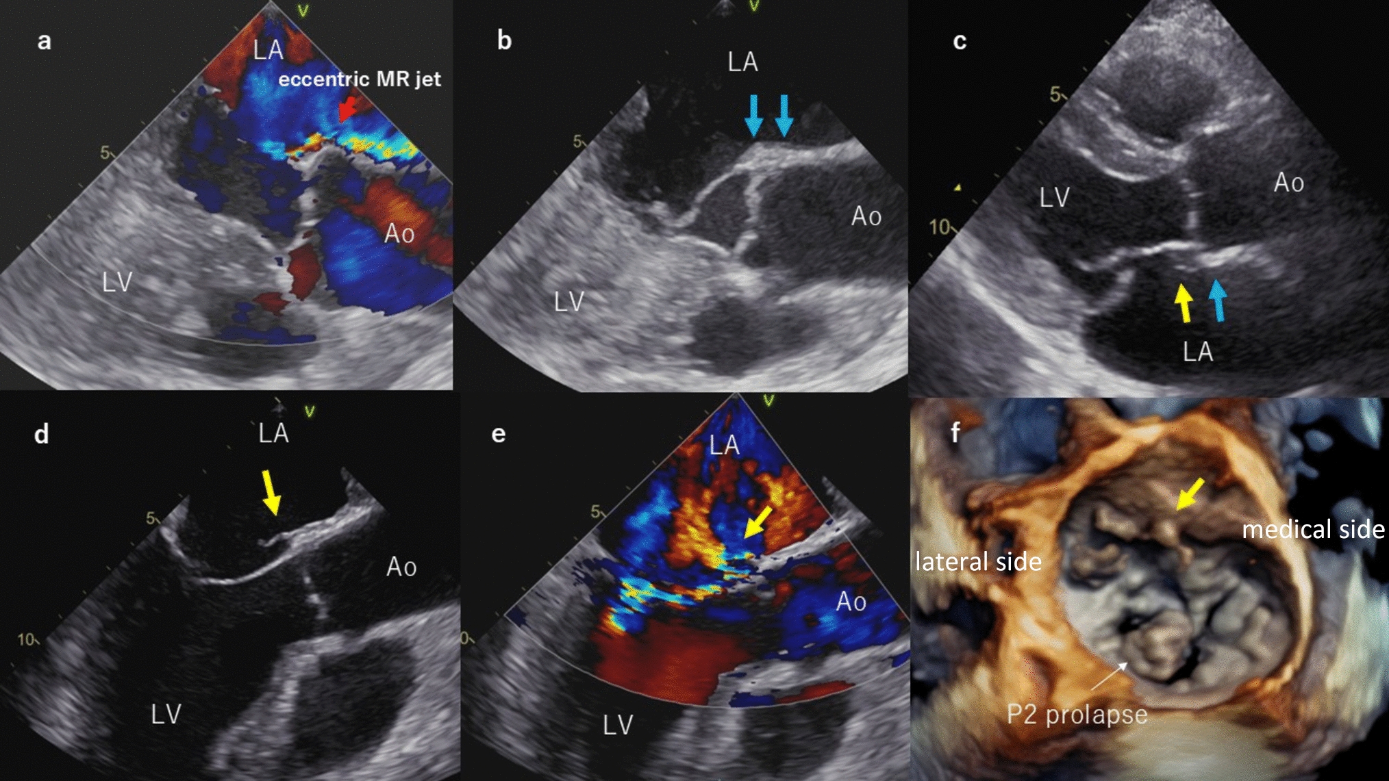 Transesophageal Echocardiography | Progressive left atrial dissection ...