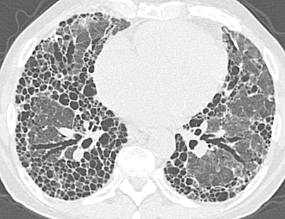 Idiopathische Lungenfibrose | SpringerLink